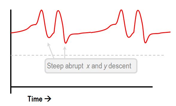 Abnormal Cvp Waveform